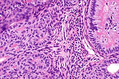 Adenomatoid odontogenic tumour - Libre Pathology