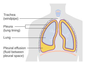 Pleural effusion - Libre Pathology