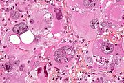 Nucleolus - Libre Pathology