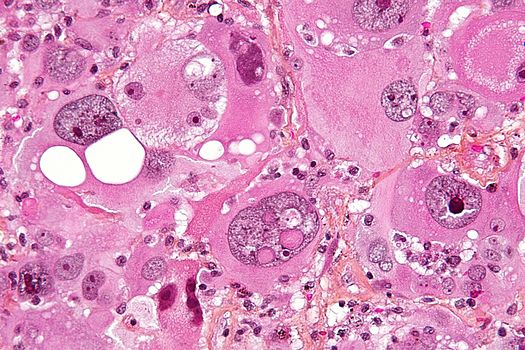 Nuclear pleomorphism - Libre Pathology