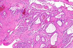Fumarate hydratase-deficient renal cell carcinoma - Libre Pathology