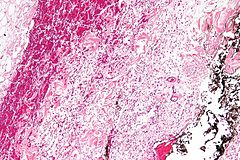 Starvation - Libre Pathology