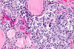 C-cell hyperplasia - Libre Pathology