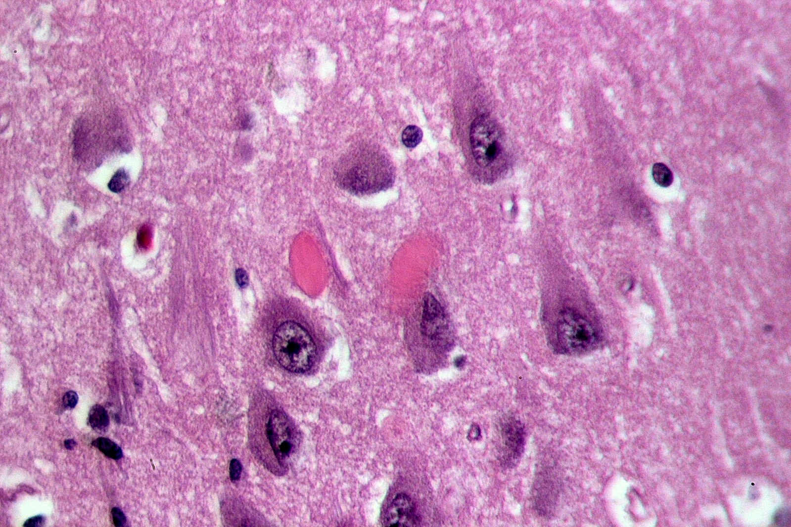 File:Hirano bodies in the Hippocampus in an old person with Alzheimer ...