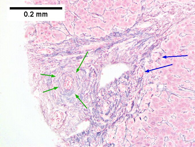 Primary Sclerosing Cholangitis Libre Pathology