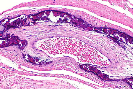 Medial calcific sclerosis - Libre Pathology