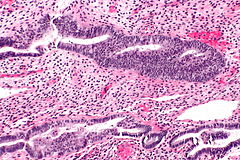 Complex endometrial hyperplasia - Libre Pathology