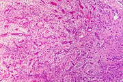 Granulation tissue - Libre Pathology