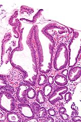 Reactive gastropathy - Libre Pathology