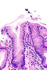 Sarcina - Libre Pathology
