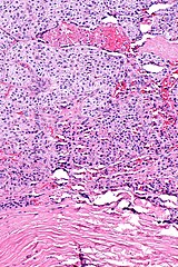 Parathyroid carcinoma - Libre Pathology