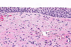Uterine cervix with atrophic changes - Libre Pathology
