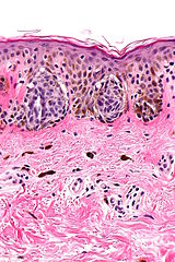 Compound nevus - Libre Pathology