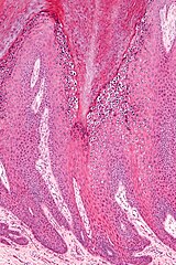 Verruca vulgaris - Libre Pathology