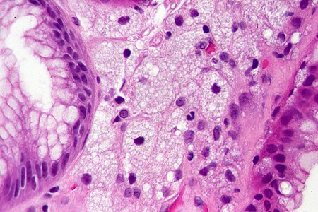 Gastric xanthoma - Libre Pathology
