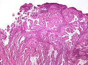 Endometrioid endometrial carcinoma - Libre Pathology