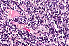 Follicular lymphoma - Libre Pathology