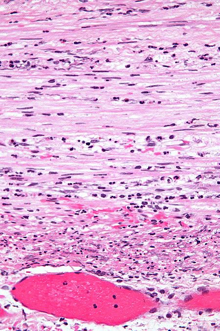 Acute appendicitis - Libre Pathology