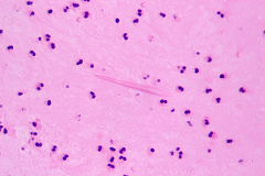 Asthma - Libre Pathology