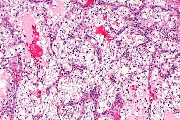 Von Hippel-Lindau disease - Libre Pathology