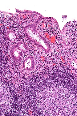 Diversion colitis - Libre Pathology