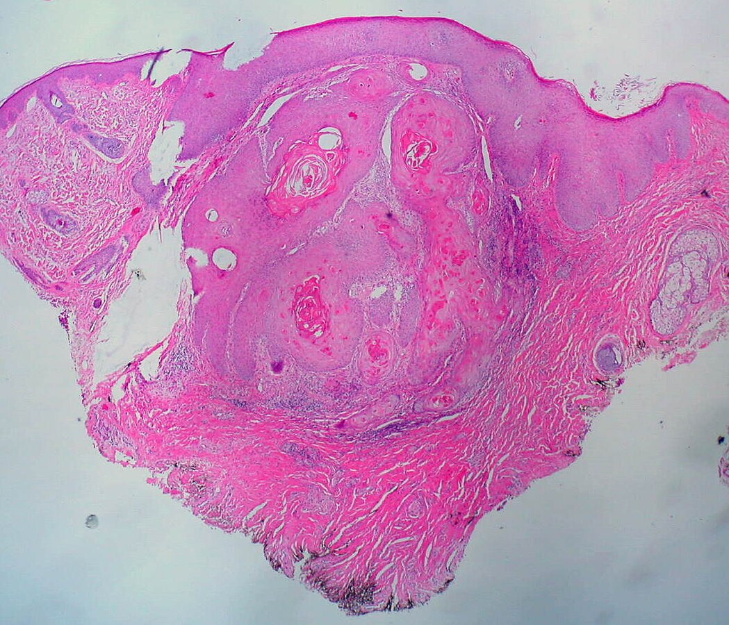 File:Keratoacanthoma (1), H&E.jpg - Libre Pathology