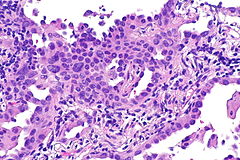 Adenocarcinoma of the lung - Libre Pathology