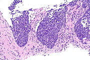 Non-small cell lung carcinoma - Libre Pathology