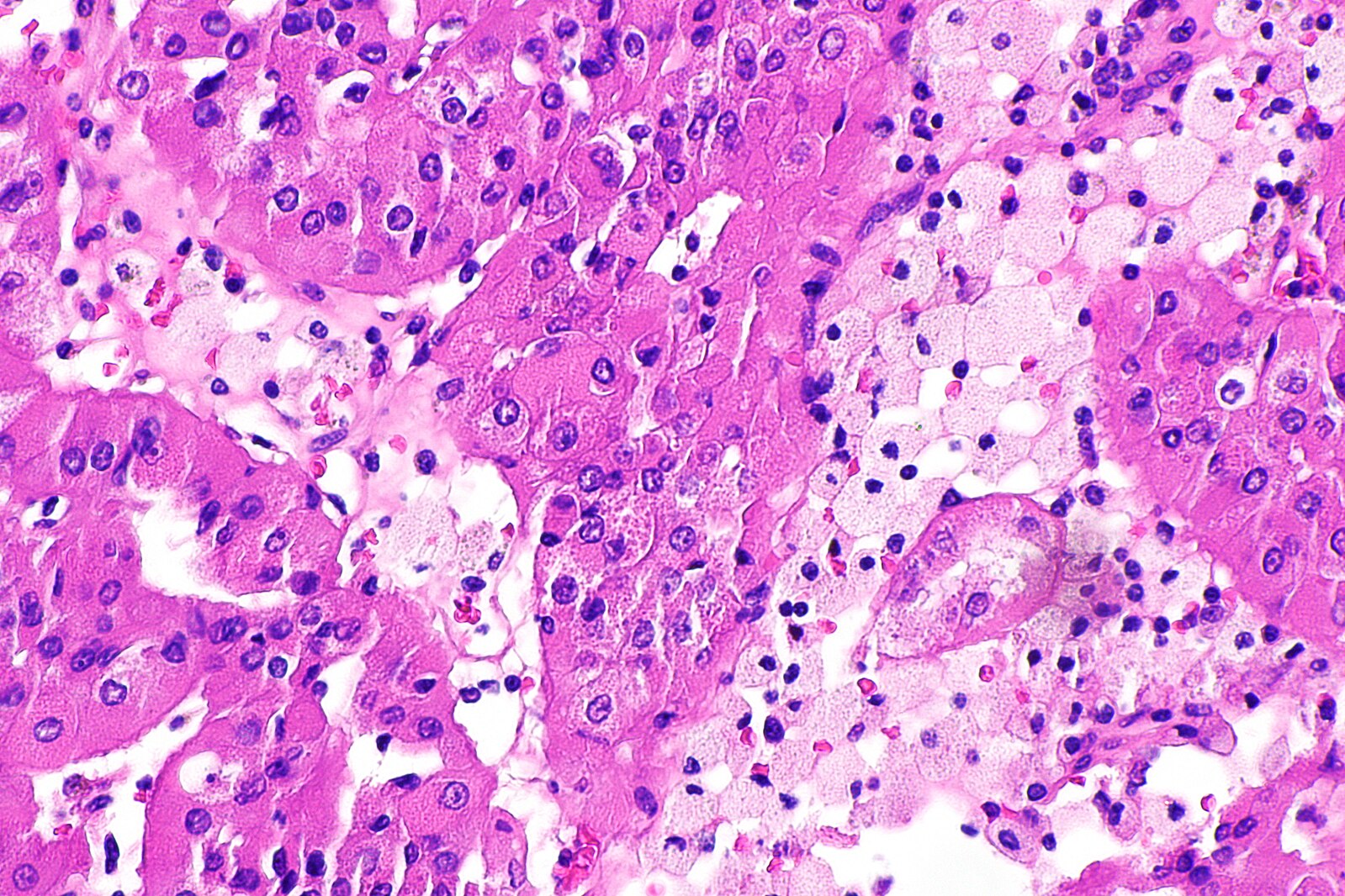 File:Eosinophilic, solid and cystic renal cell carcinoma - histiocytes ...