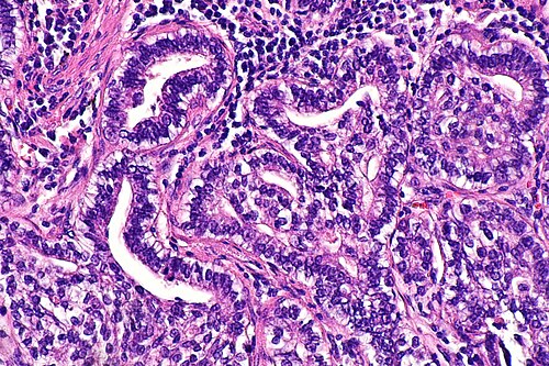 lung cancer histology quiz