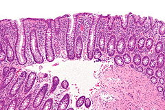 Lymphocytic colitis - Libre Pathology