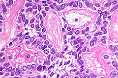 Adenoid cystic/basal cell carcinoma of the prostate - Libre Pathology