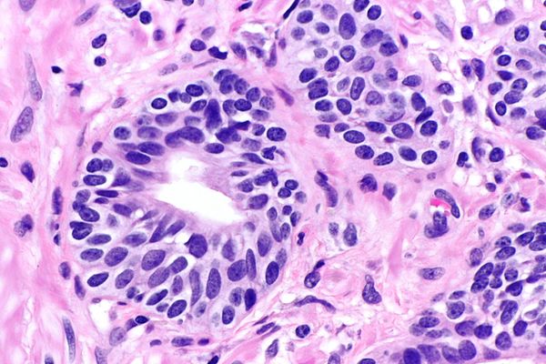 Basal cell hyperplasia of the prostate - Libre Pathology