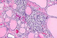C-cell hyperplasia - Libre Pathology