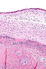 Chorioamnionitis - Libre Pathology