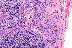 Nodal nevus - Libre Pathology