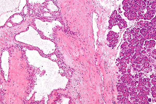 Serous cystadenoma of the pancreas - Libre Pathology