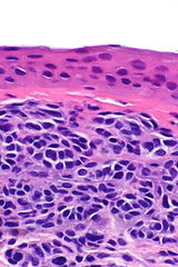 Conjunctival nevus - Libre Pathology