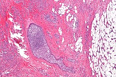 Invasive lobular carcinoma - Libre Pathology