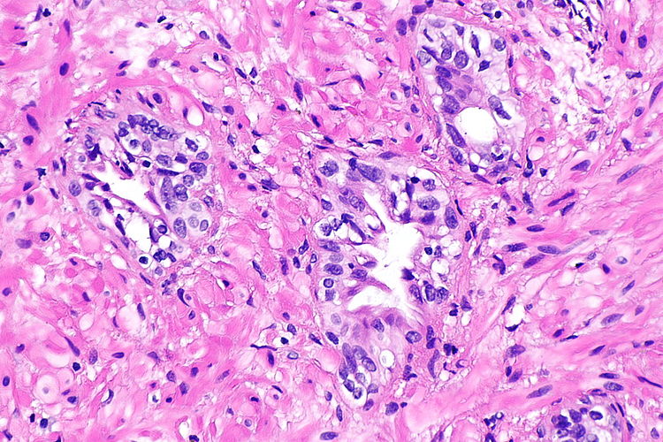 Case 95 - Libre Pathology