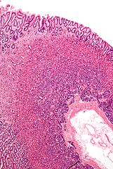 Signet ring cell carcinoma - Libre Pathology