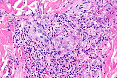 Small vessel leukocytoclastic vasculitis - Libre Pathology