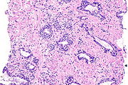 Basal cell hyperplasia of the prostate - Libre Pathology