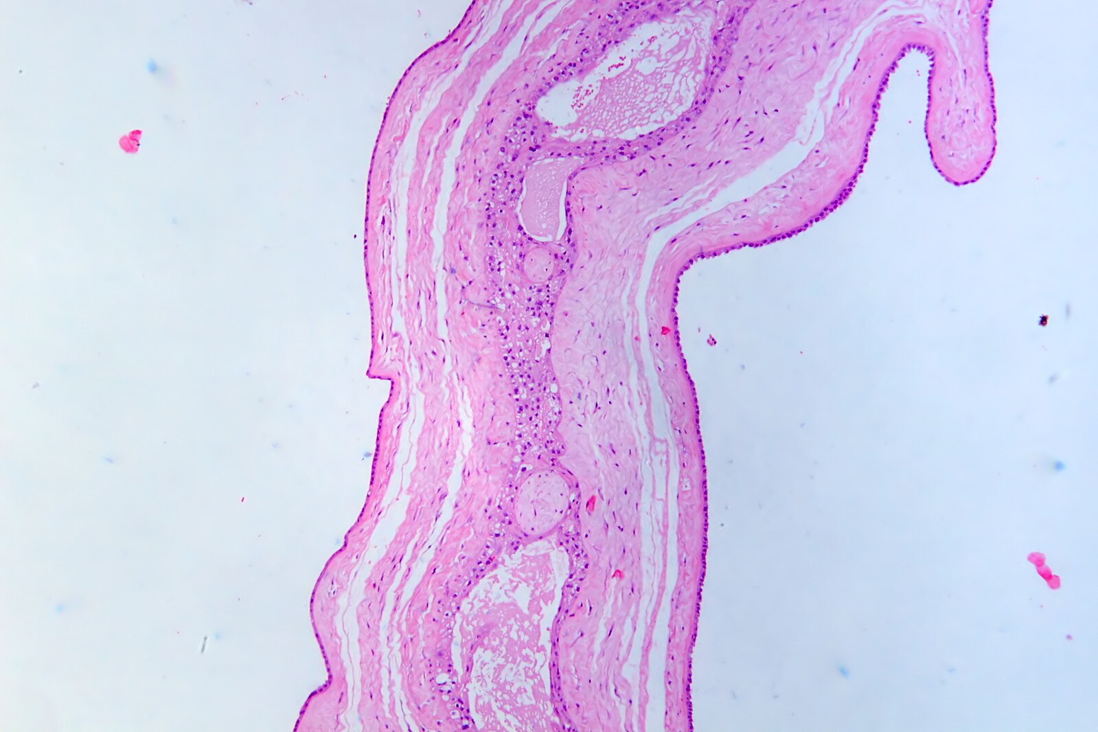 File:Diamniotic dichorionic placenta, HE 1.jpg - Libre Pathology