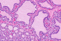 Graves' disease - Libre Pathology