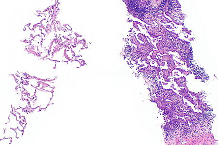 Adenocarcinoma of the lung - Libre Pathology