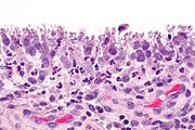 Acute synovitis - Libre Pathology