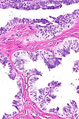 Adenomatous hyperplasia of the rete testis - Libre Pathology