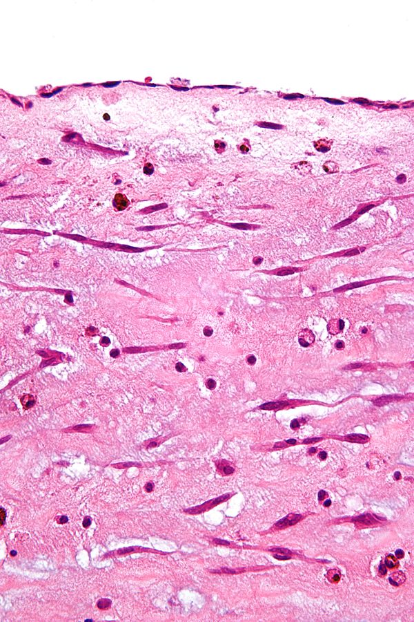 Cardiac myxoma - Libre Pathology