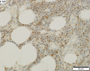 Thymoma - Libre Pathology
